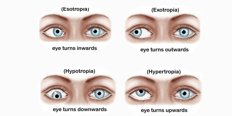 Squint Specialist in Mumbai | Thane | Wavikar Eye Institute