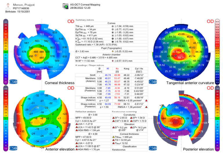 Keratoconus: A Comprehensive Guide to Diagnosis and Treatment - Wavikar ...