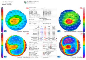 Keratoconus: A Comprehensive Guide to Diagnosis and Treatment - Wavikar ...