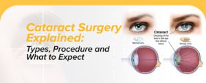 Cataract Surgery Explained: Types, Procedure, and What to Expect