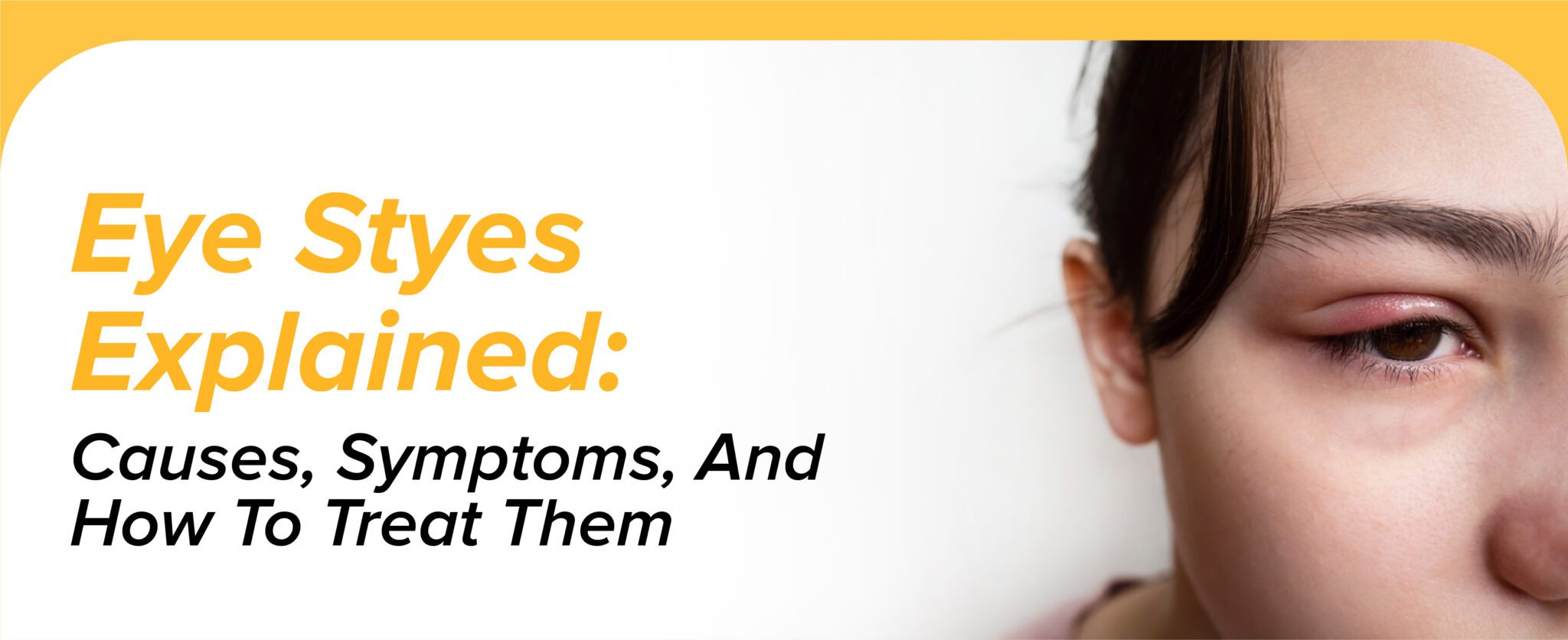 Eye Stye: Causes, Symptoms & Treatment Guide | Wavikar Eye Institute