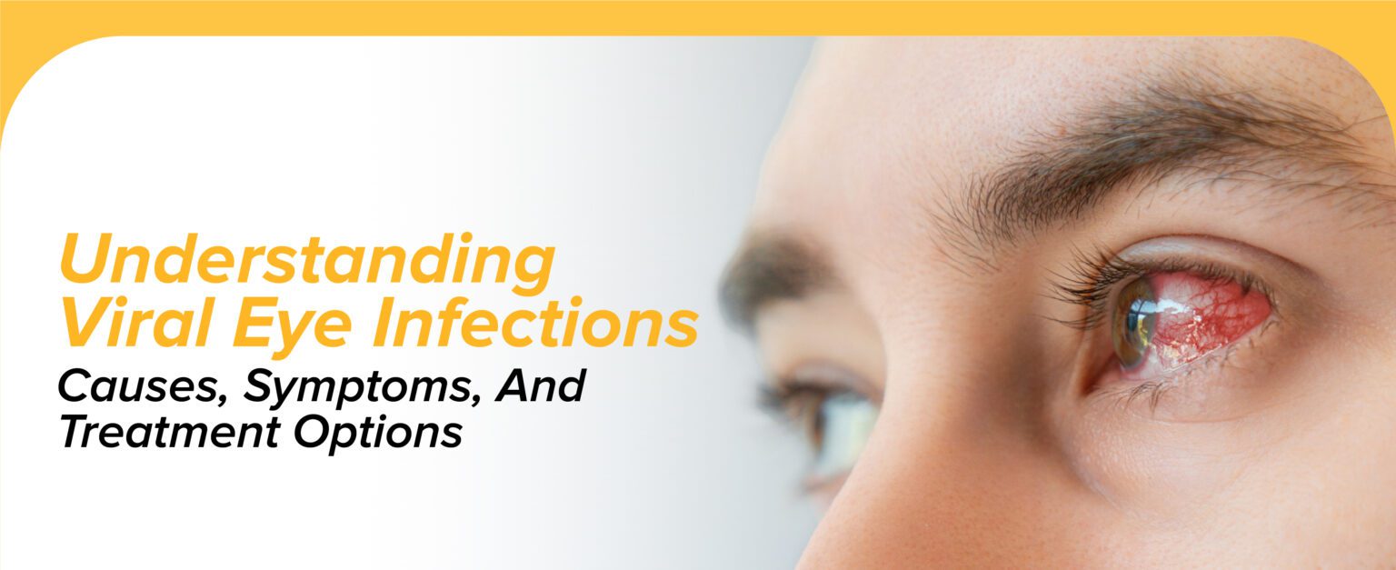 Understanding Viral Eye Infections: Causes, Symptoms, and Treatment ...
